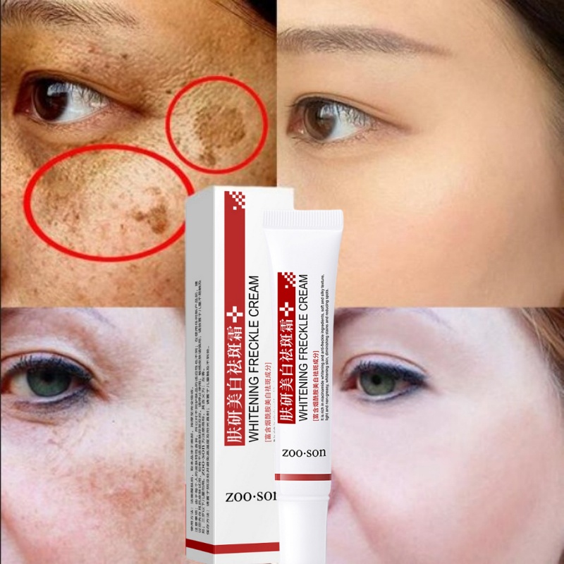 Crema Blanqueadora De Pecas Eliminar Manchas Oscuras Cremas Faciales Anti Niacinamida Desvanecer ...