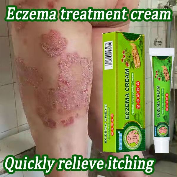 Y95 Crema De Tratamiento De Eczema gamot sa kati balat buni La ...